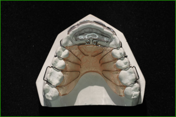 Spring Aligner Hawley - Arcade